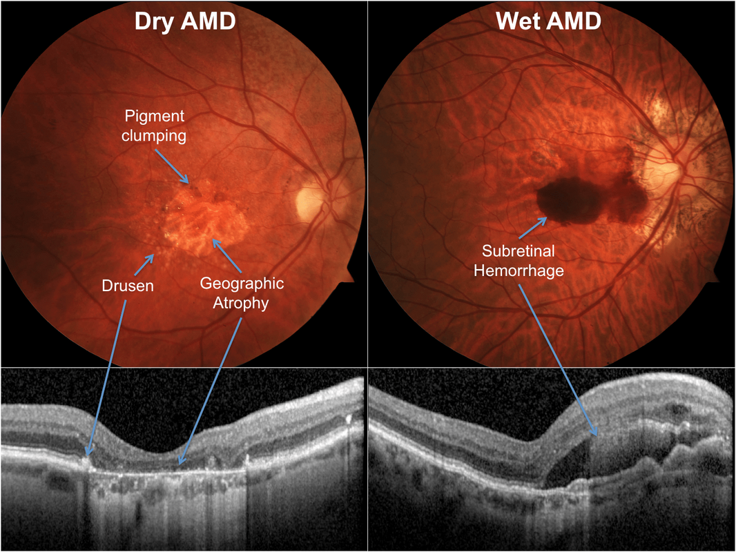Macular Degeneration (AMD) Causes & Treatments